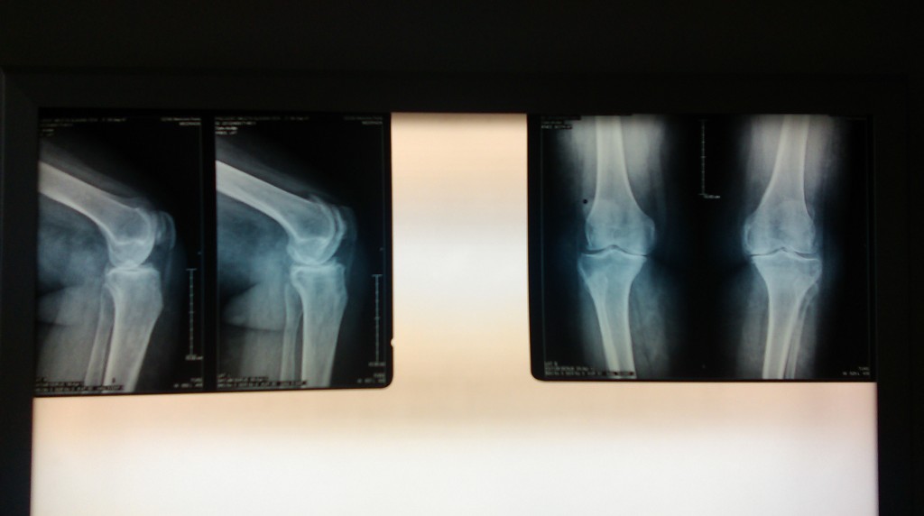 Rehabilitacija - Povreda kolena - Meniskus - LCA - Pro Fizio